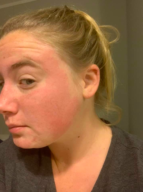 Some people are having terrible reactions to popular face mask – so it ...