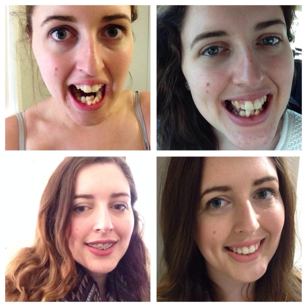 15 drastic transformations of people before and after braces