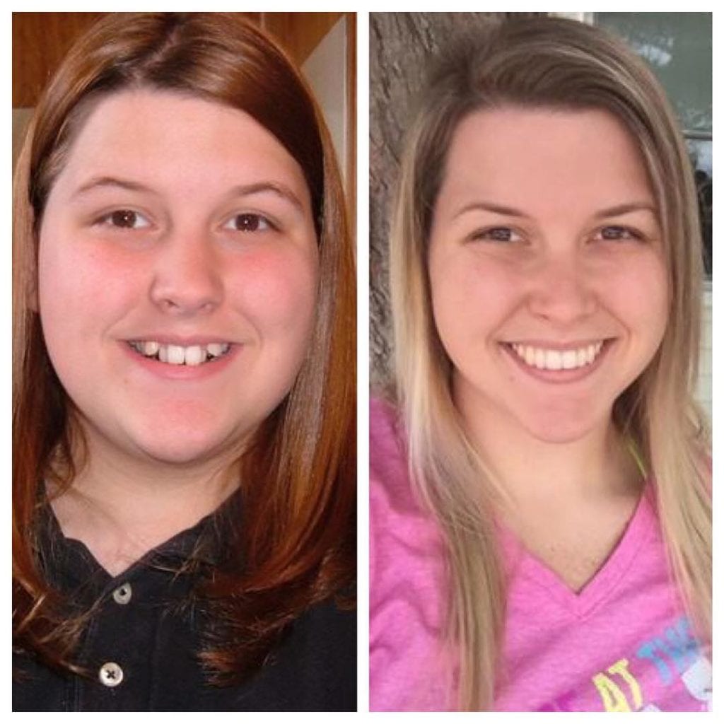 15 drastic transformations of people before and after braces