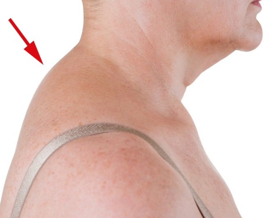 Chiropractor shares 3 simple exercises to help get rid of ugly neck humps