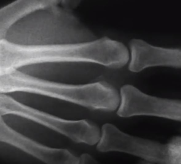 Do you crack your knuckles? Here’s what happens when you do